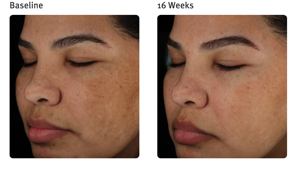 Epionce Irregular Pigmentation Protocol | Lifted Beauty + Wellness