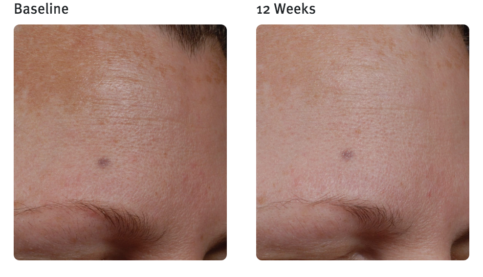 Epionce Irregular Pigmentation Protocol | Lifted Beauty + Wellness