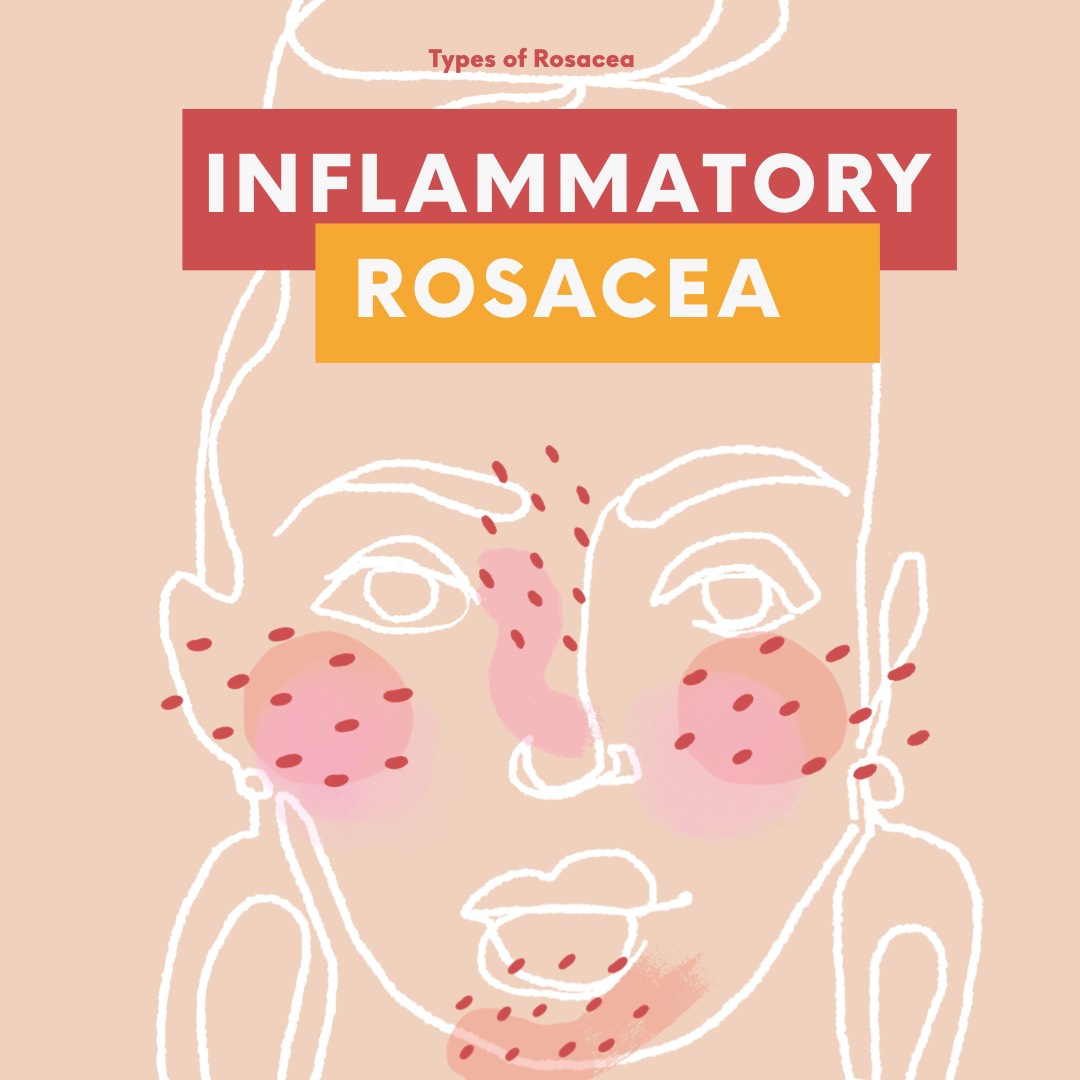 Understanding The Signs of Rosacea | Lifted Beauty + Wellness