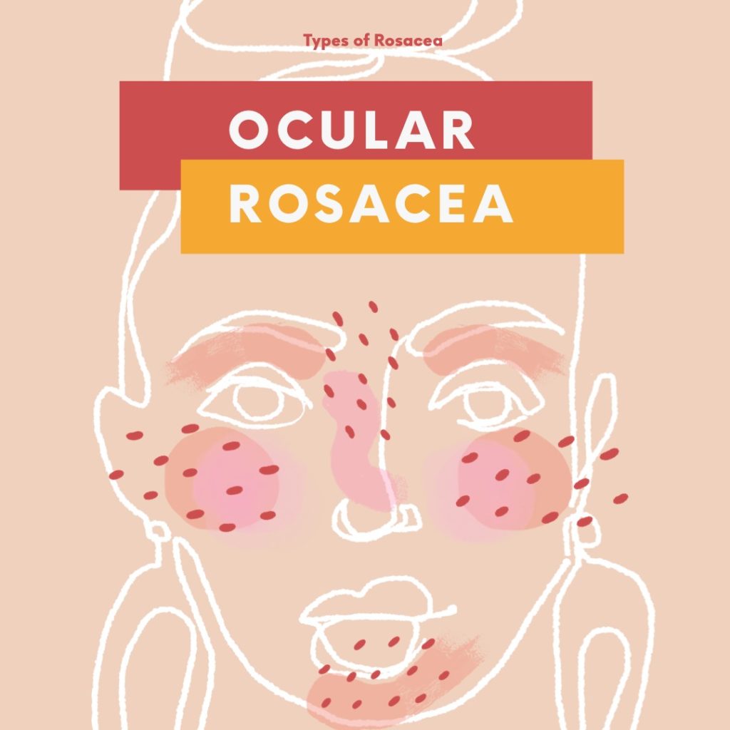 Understanding The Signs of Rosacea | Lifted Beauty + Wellness