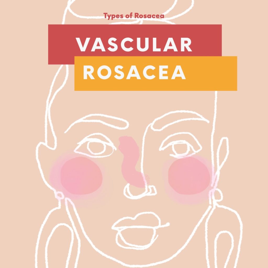 Understanding The Signs of Rosacea | Lifted Beauty + Wellness