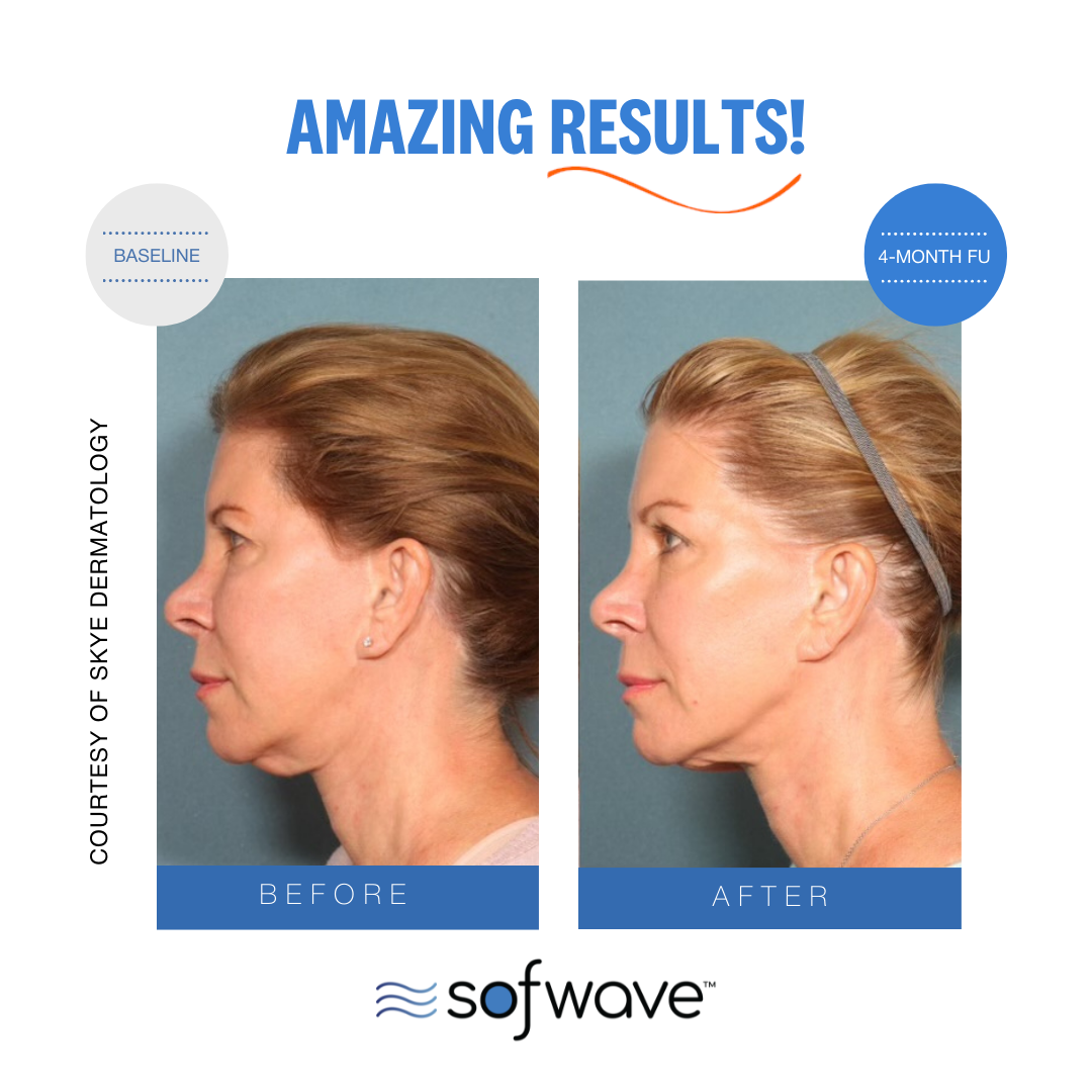Sofwave™ Wrinkle Treatments - Lifted Beauty + Wellness